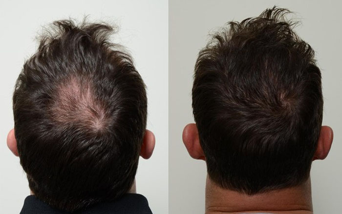 Artificial Hair Bio Fibers – AG Skin And Hair Transplant Clinic